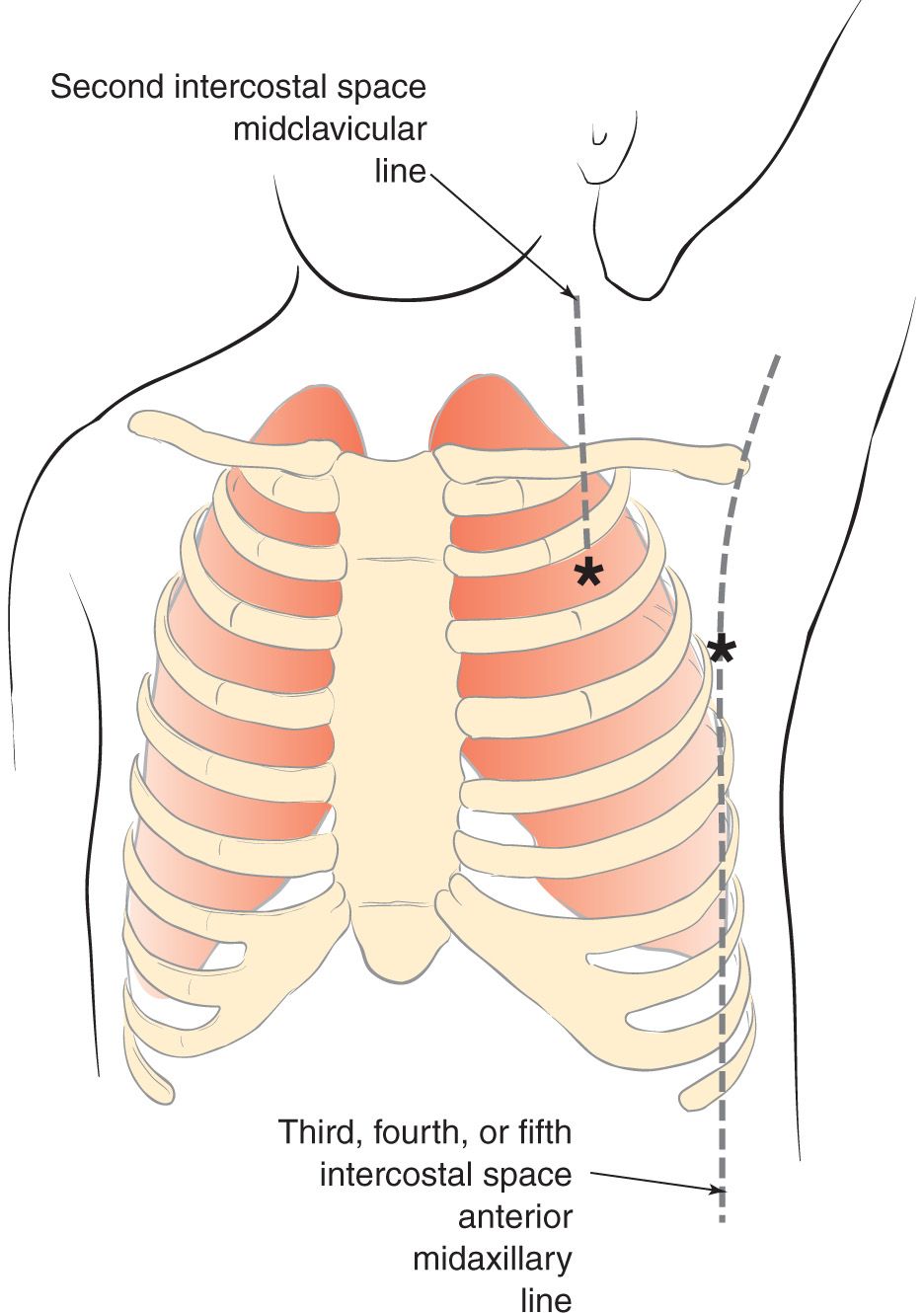 Tube Thoracostomy Anesthesia Key