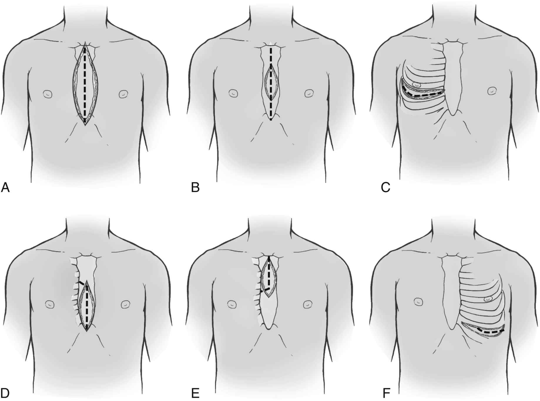Lateral Approach