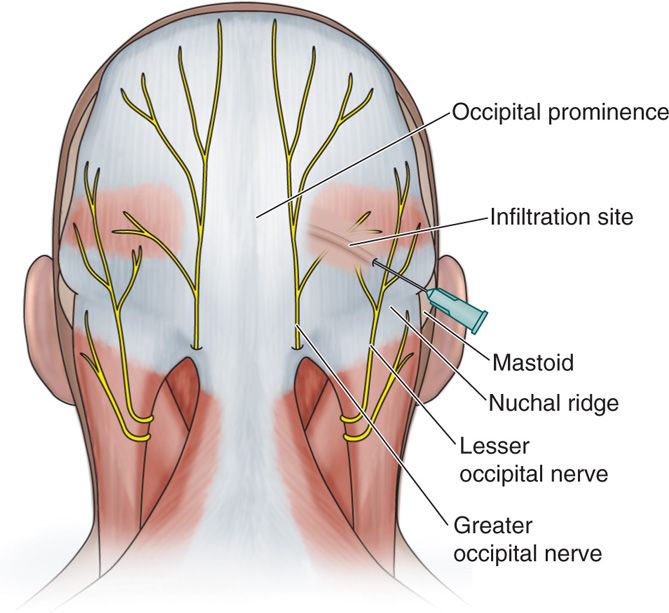 Occipital Nerve Nerve Entrapment Occipital Occipital Occipital Nerve Nerve Entrapment Occipital Occipital