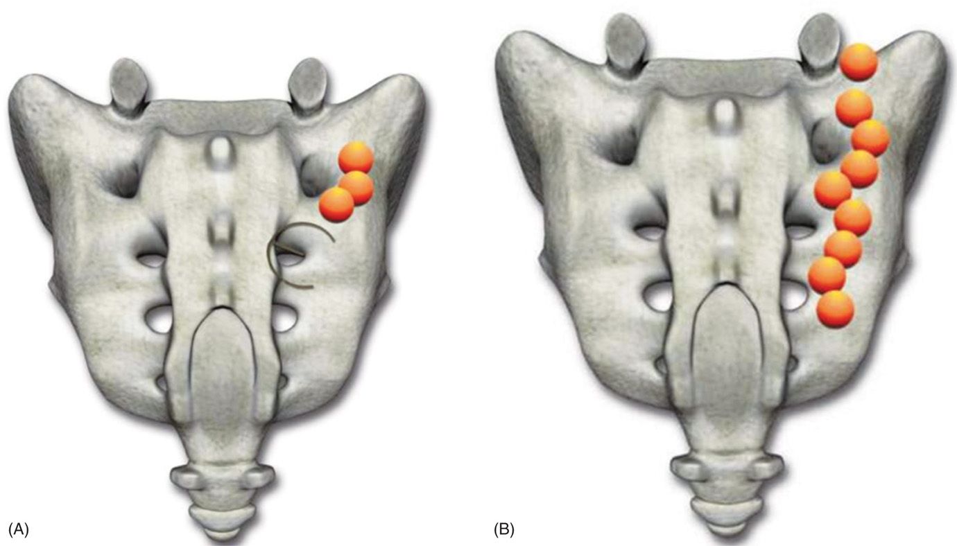 Sacroiliac Joint Denervation Using Synergy System Anesthesia Key Sacroiliac Joint Denervation Using Synergy System Anesthesia Key