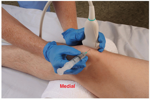 Ultrasound Guided Injection Technique For Prepatellar Bursitis Pain
