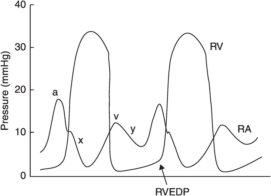 Chapter 11 – Tricuspid and Pulmonary Valve Surgery | Anesthesia Key