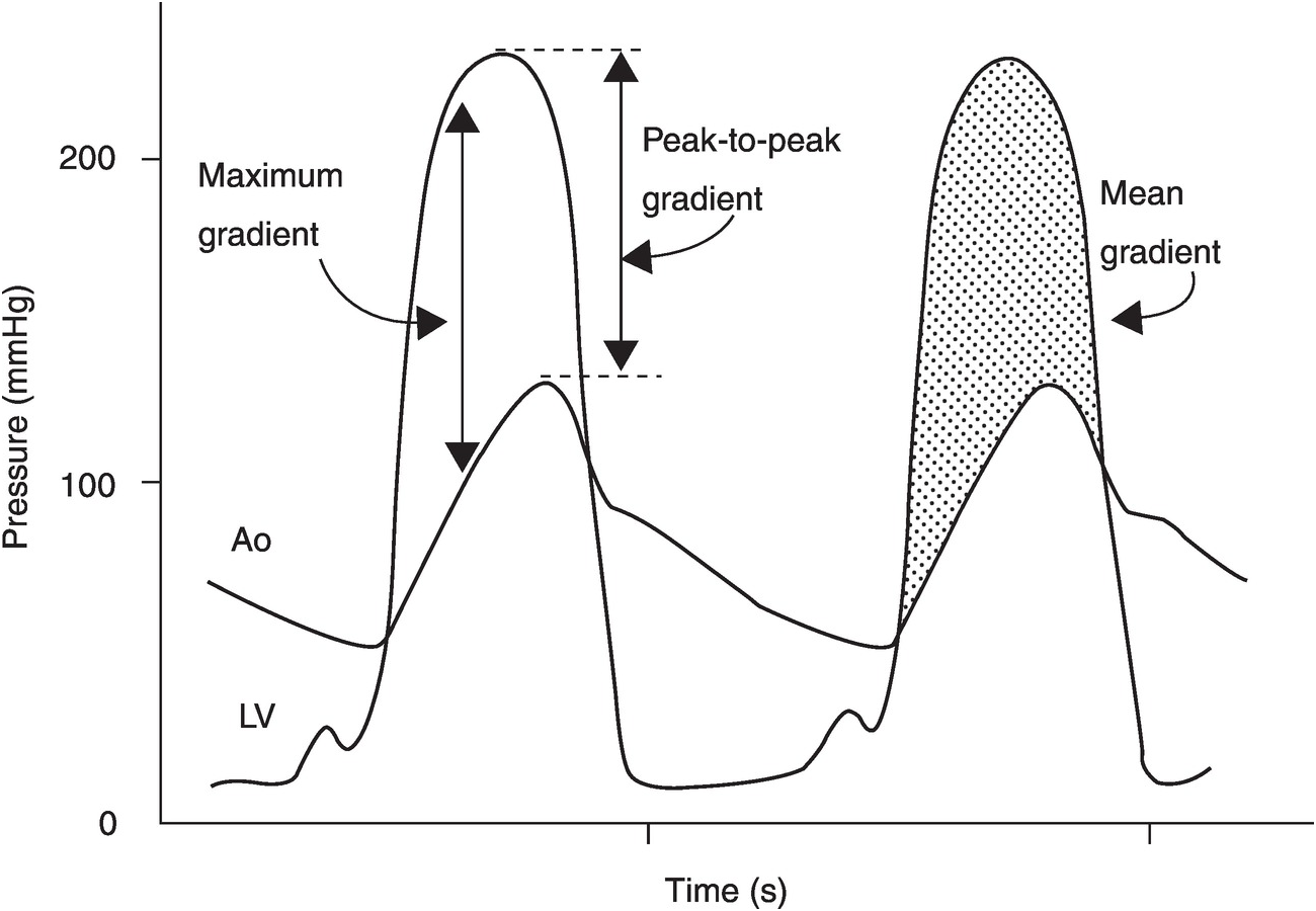 Chapter 9 – Aortic Valve Surgery | Anesthesia Key