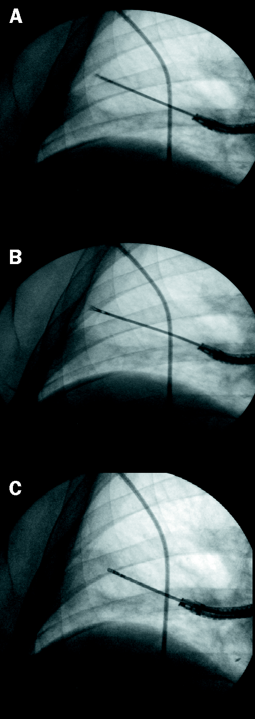 10 – Transbronchial Lung Biopsy | Anesthesia Key