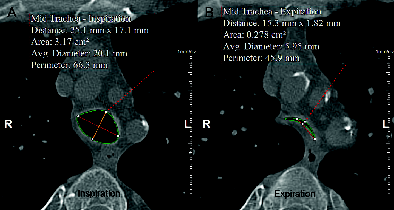 4 – Airway Anatomy for the Bronchoscopist | Anesthesia Key