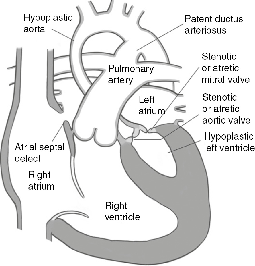 28 – Congenital Heart Disease in the Neonate and Infant | Anesthesia Key