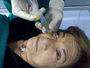 Chapter 29 – Cataract Surgery | Anesthesia Key