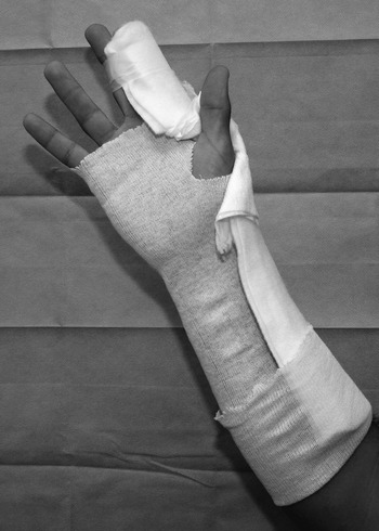 Chapter 10 – Immobilization and splinting | Anesthesia Key