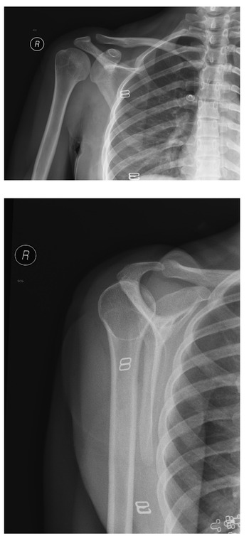 Chapter 2 – Shoulder and elbow emergencies | Anesthesia Key