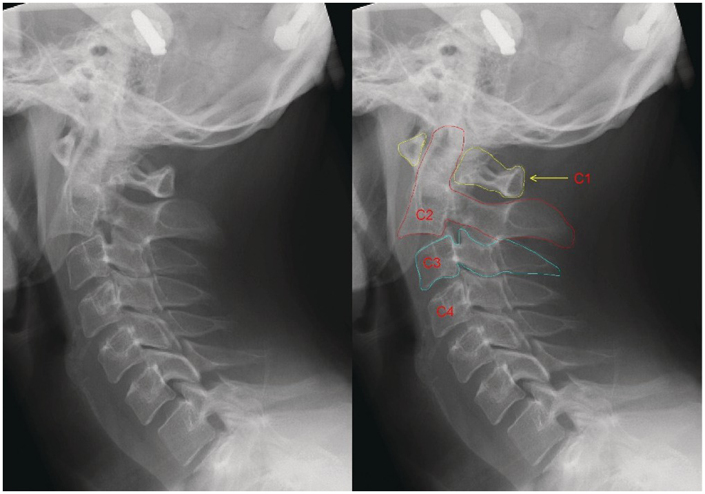 Chapter 10 – Cervical Spine Trauma | Anesthesia Key