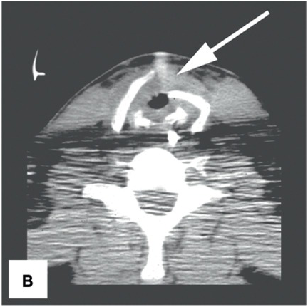 Chapter 12 – Neck Trauma | Anesthesia Key