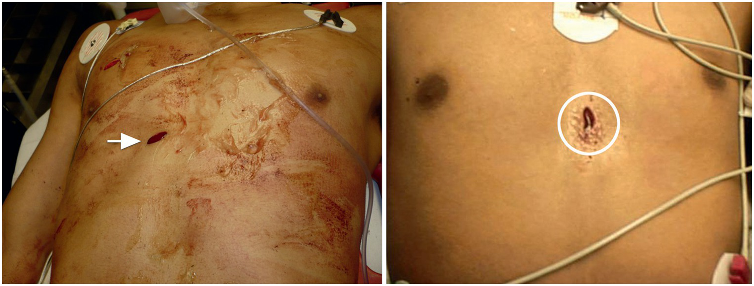 Chapter 14 – Cardiac Trauma | Anesthesia Key