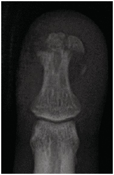 Chapter 19 – Upper Extremity Trauma | Anesthesia Key
