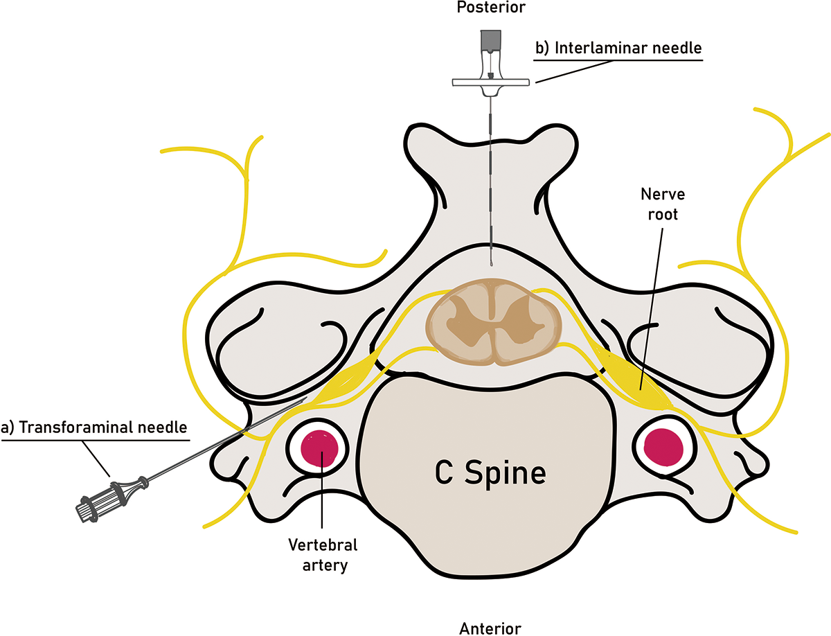 Complications Of Cervical Epidural Steroid Injection Anesthesia Key