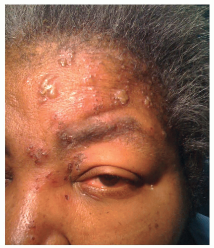 Herpes Zoster Ophthalmicus Anesthesia Key