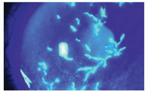 Herpes Zoster Ophthalmicus Anesthesia Key
